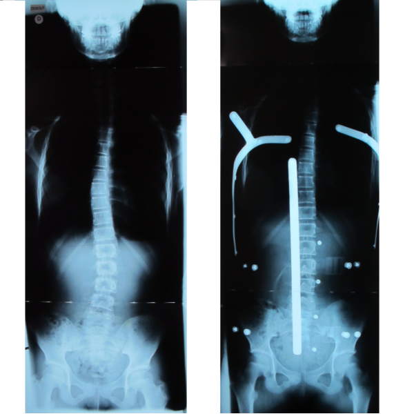 Corset C.T.M./ Cheneau - Corsets de traitement scoliose - NEUT